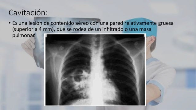 Radiología de Torax-Quistes, Bullas y Cavitaciones