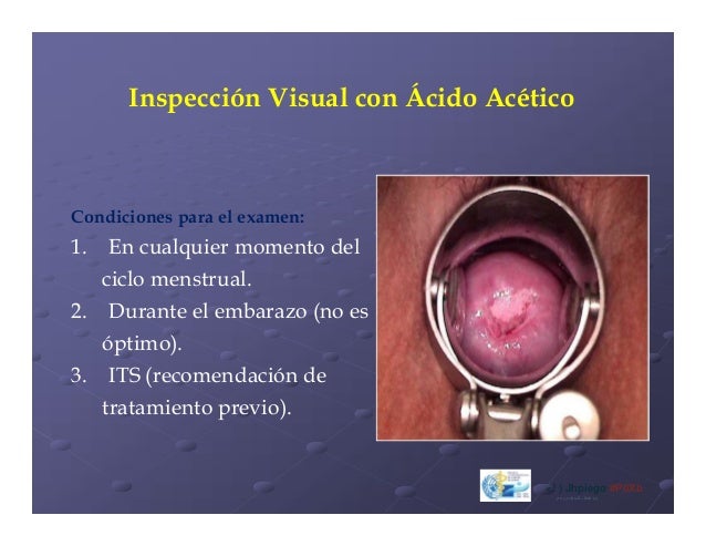PRECANCER DE CERVIX