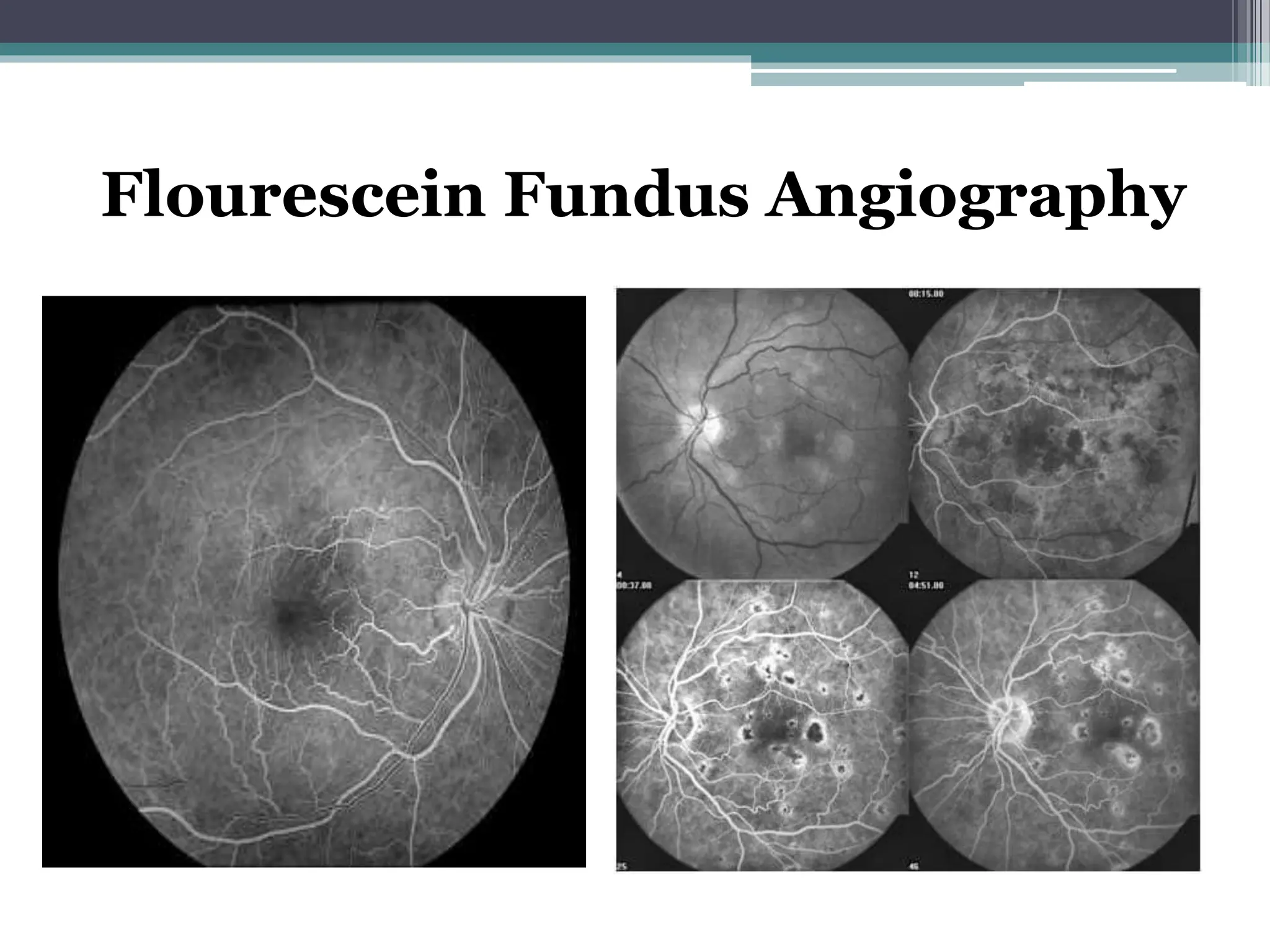 DYES IN OPHTHOMOLOGY - trypan blue, lissamine, flourescine.pptx | Eye ...
