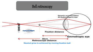 BASICS DYNAMIC AND STATIC RETINOSCOPY... | PPTX