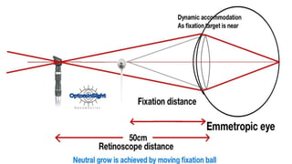 BASICS DYNAMIC AND STATIC RETINOSCOPY... | PPTX
