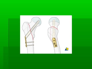 Dynamic hip screw | PPT