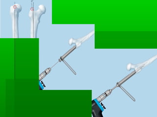 Dynamic hip screw | PPT