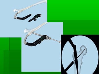 Dynamic hip screw | PPT