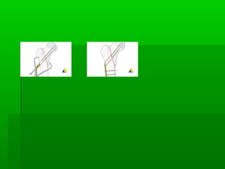 Dynamic hip screw | PPT