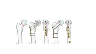 Dynamic hip screw | PPTX