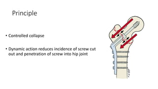 Dynamic hip screw | PPTX