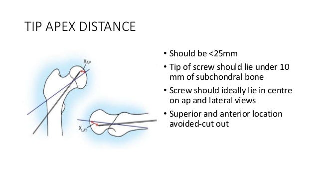 Dynamic hip screw