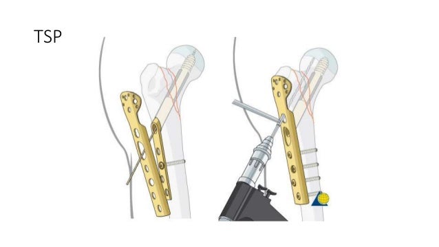 Dynamic hip screw