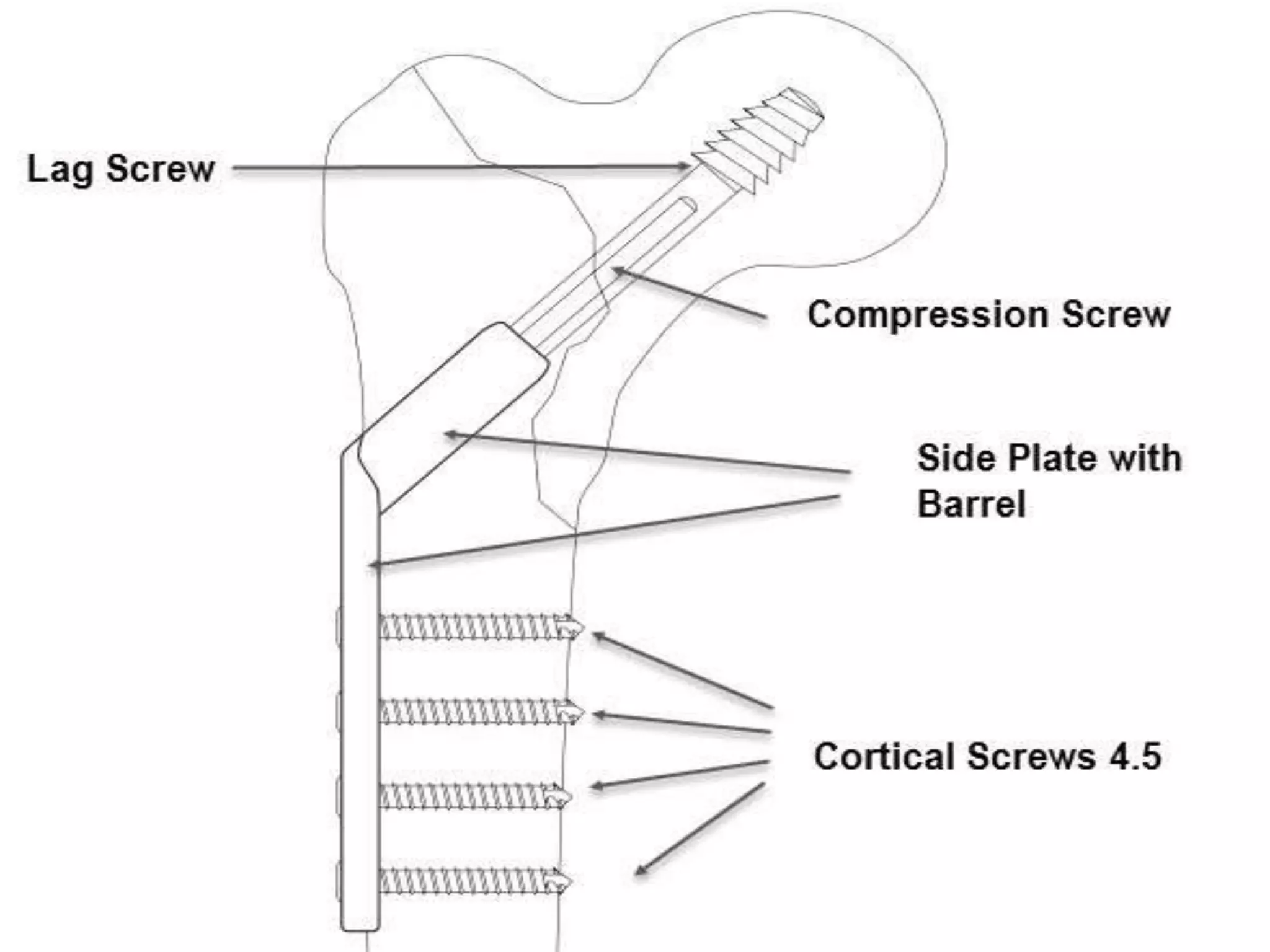 Dynamic Hip Screw Plating | PPTX