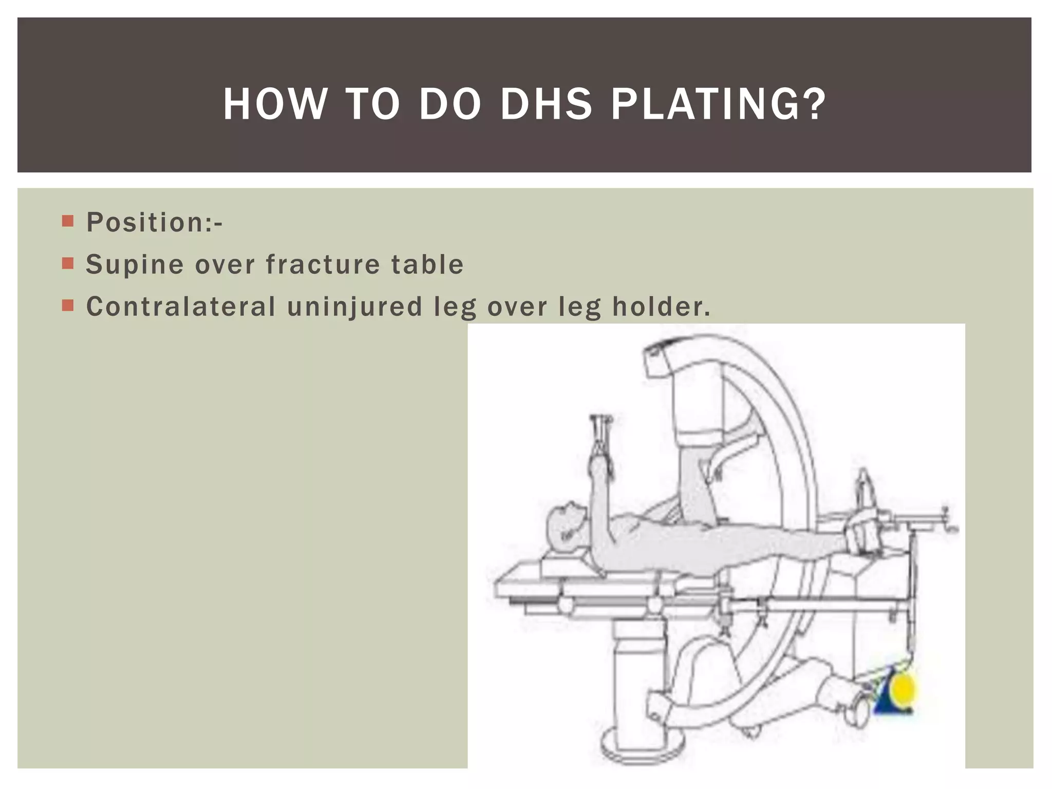 Dynamic Hip Screw Plating | PPTX