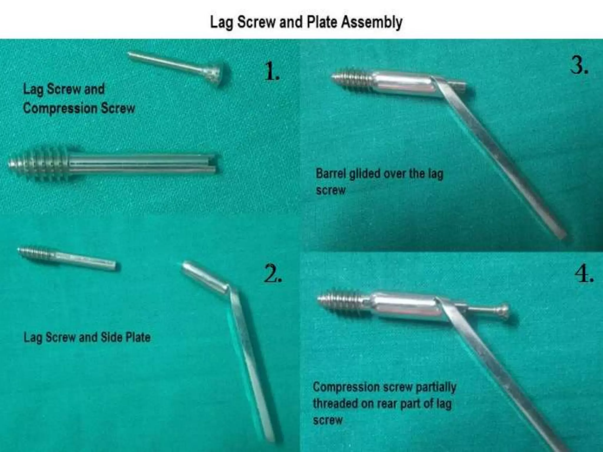 Dynamic Hip Screw Plating | PPTX