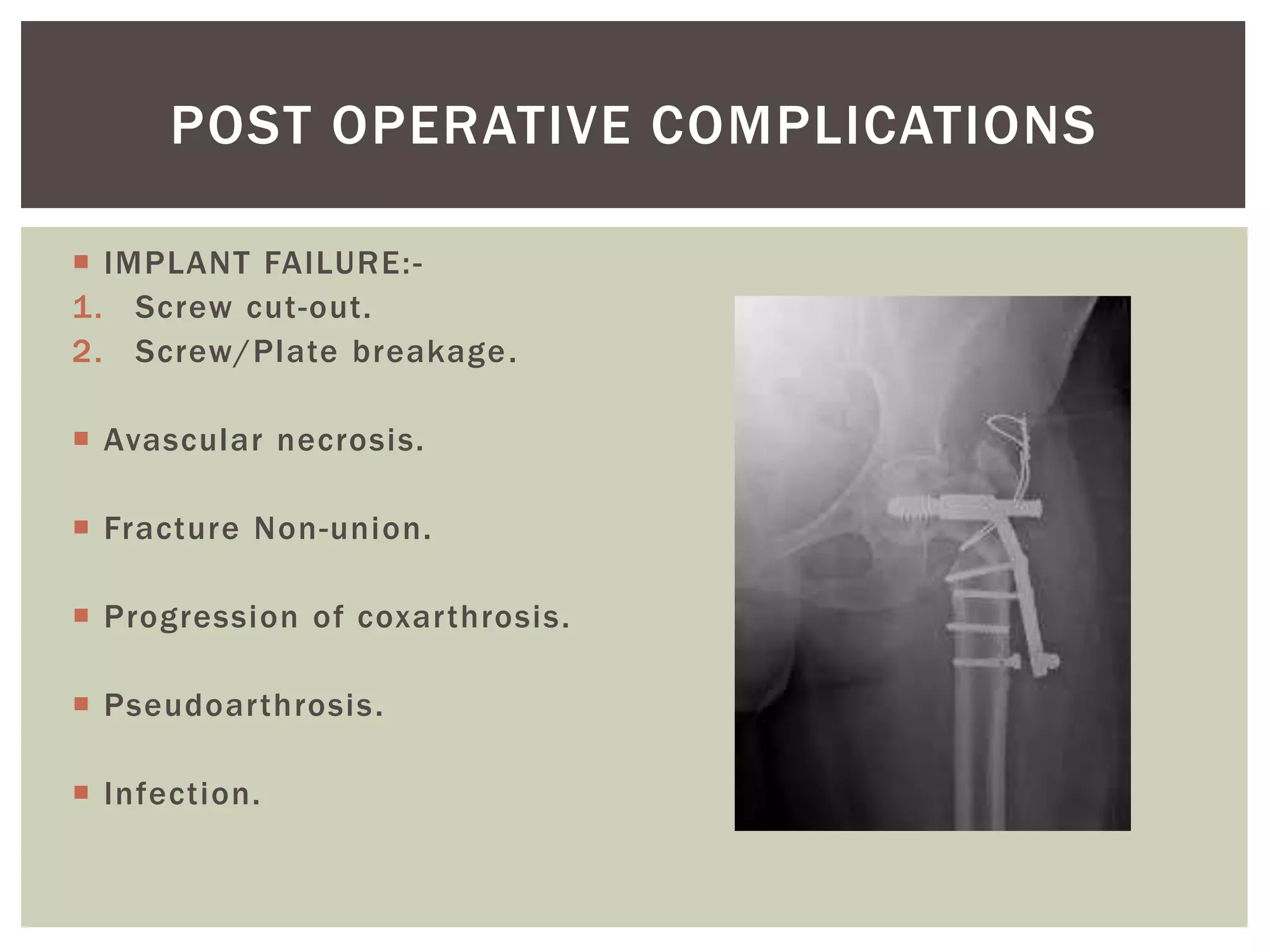 Dynamic Hip Screw Plating | PPTX