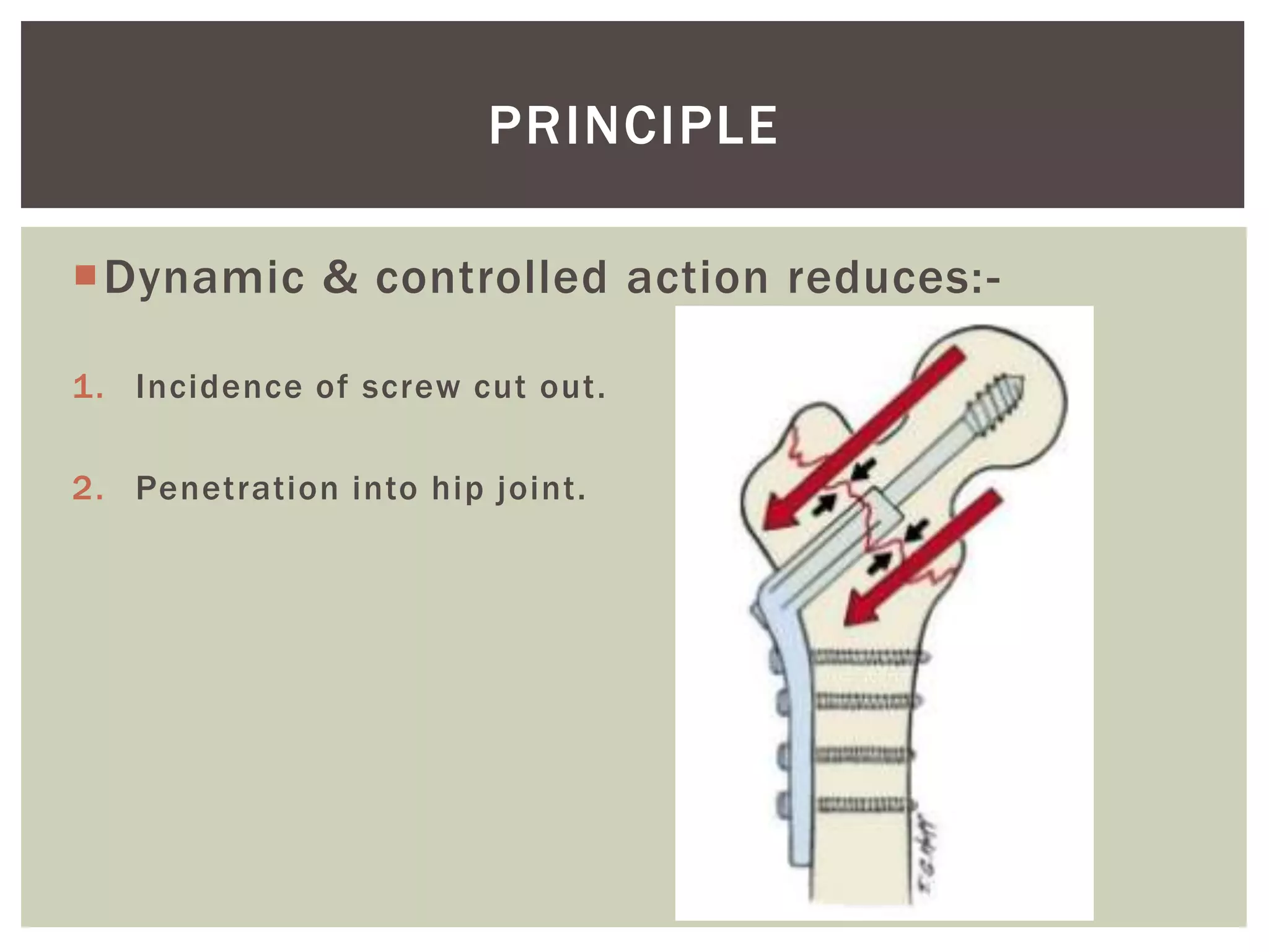 Dynamic Hip Screw Plating | PPTX