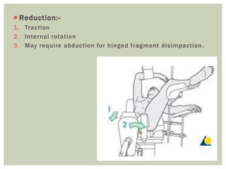 Dynamic Hip Screw Plating | PPTX