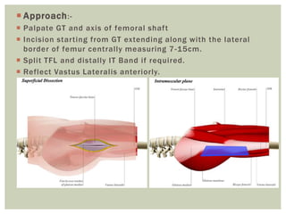 Dynamic Hip Screw Plating | PPTX