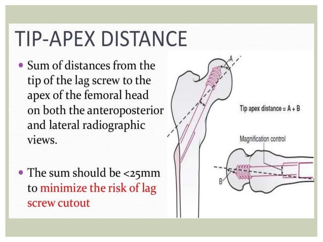 Dynamic Hip Screw Plating | PPTX