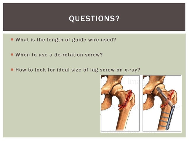 Dynamic Hip Screw Plating | PPTX