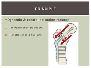 Dynamic Hip Screw Plating | PPTX