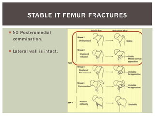 Dynamic Hip Screw Plating | PPTX