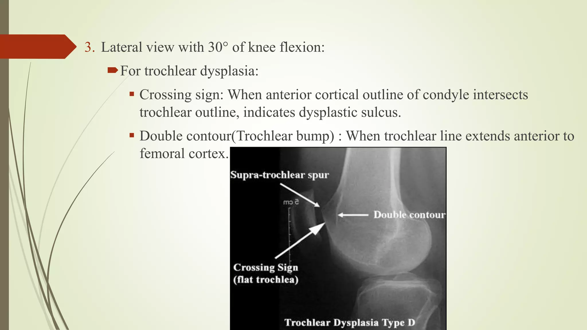 Dynamic medial patellofemoral ligament reconstruction in recurrent patellar instability | PPT