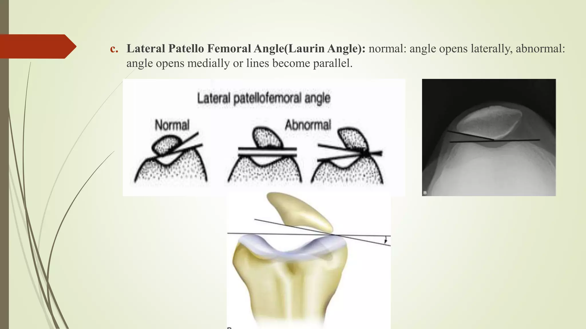 Dynamic medial patellofemoral ligament reconstruction in recurrent ...