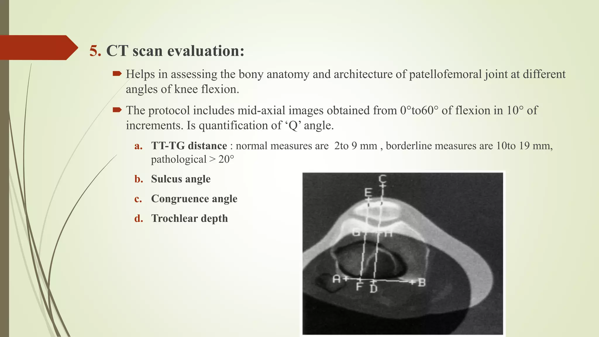 Dynamic medial patellofemoral ligament reconstruction in recurrent ...