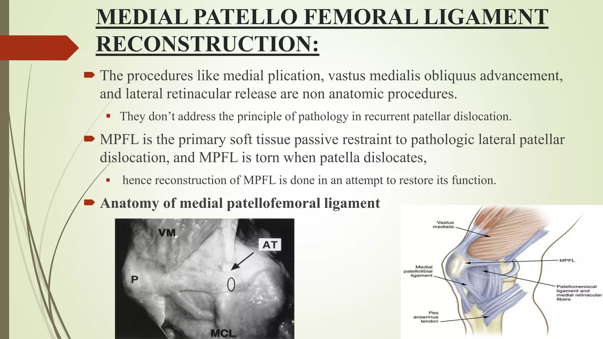Dynamic medial patellofemoral ligament reconstruction in recurrent ...