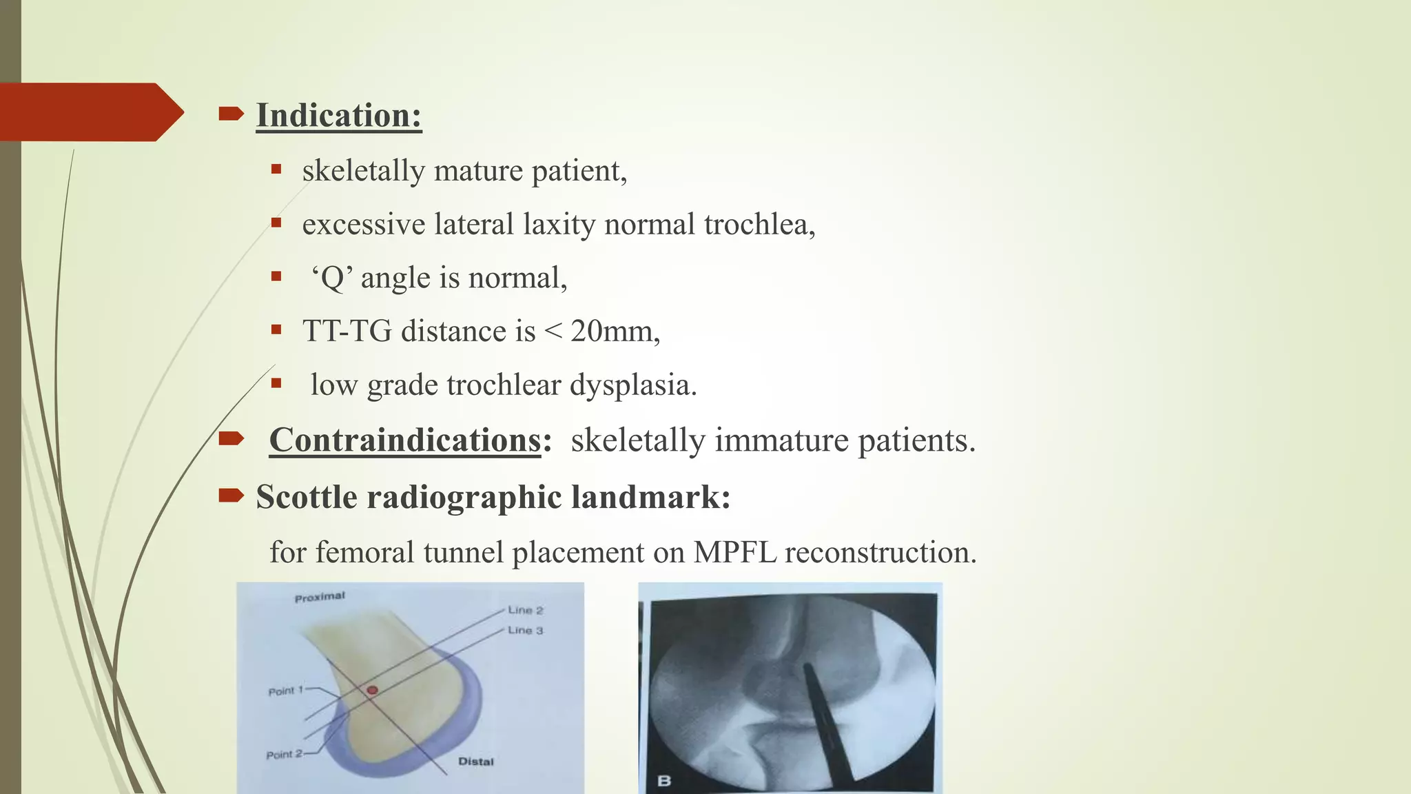 Dynamic medial patellofemoral ligament reconstruction in recurrent ...