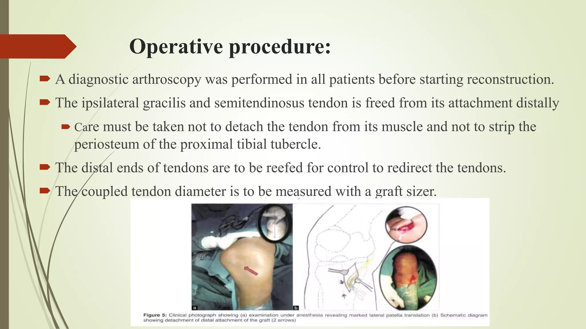 Dynamic medial patellofemoral ligament reconstruction in recurrent ...