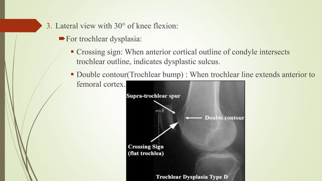 Dynamic medial patellofemoral ligament reconstruction in recurrent ...