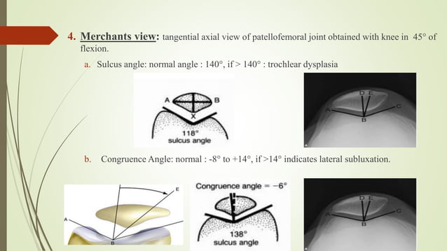 Dynamic medial patellofemoral ligament reconstruction in recurrent ...