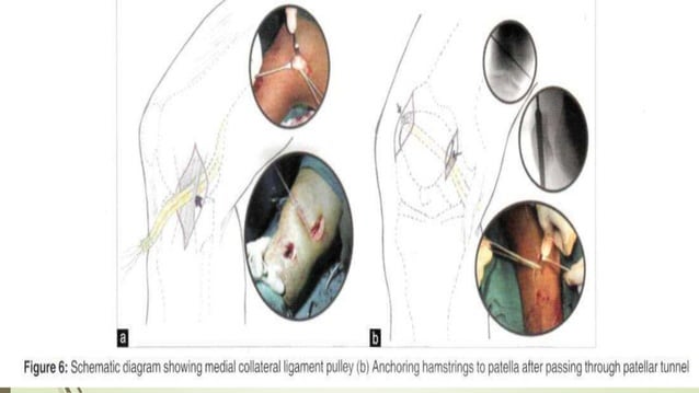 Dynamic medial patellofemoral ligament reconstruction in recurrent ...