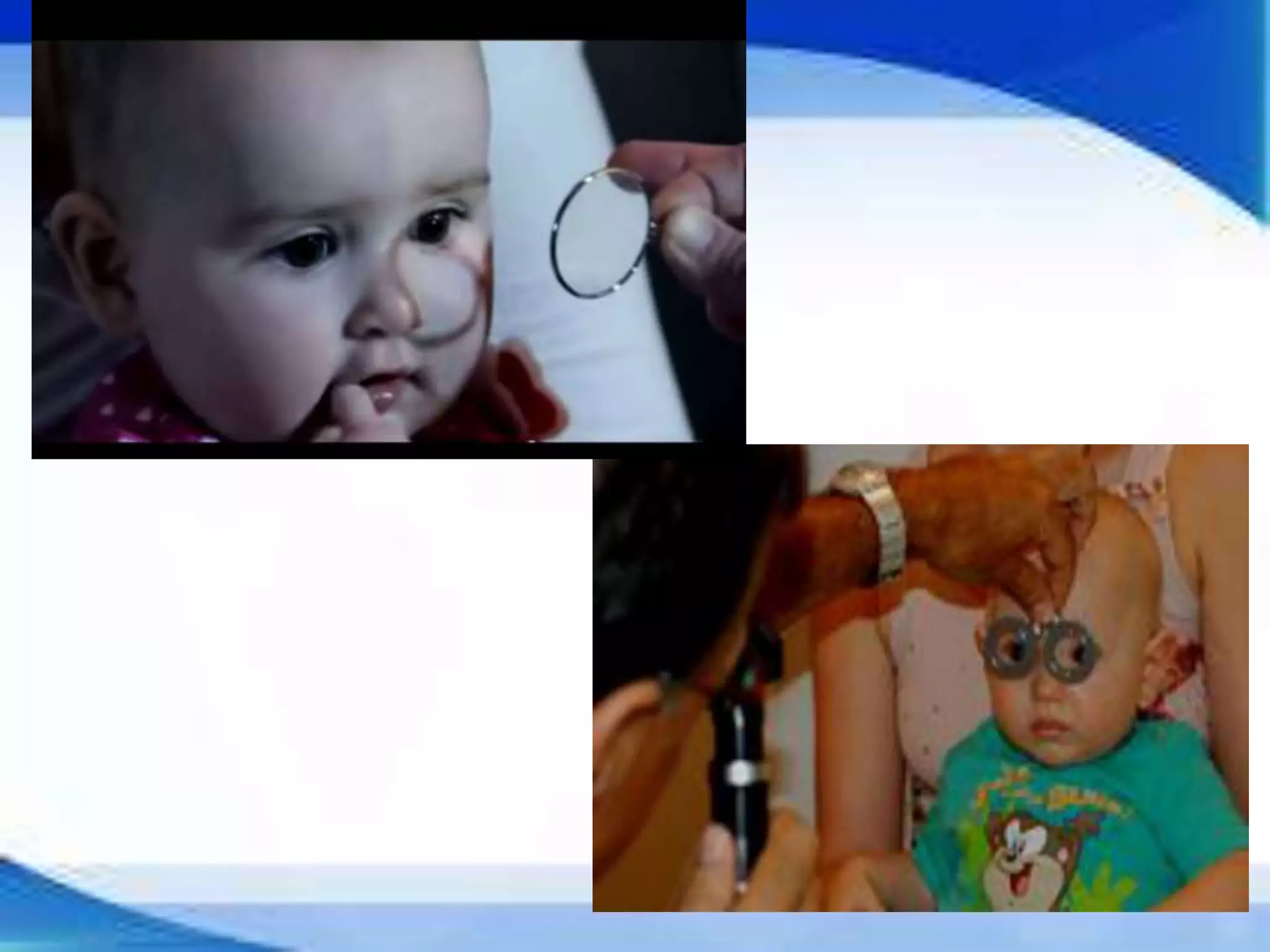 Dynamic retinoscopy | PPTX