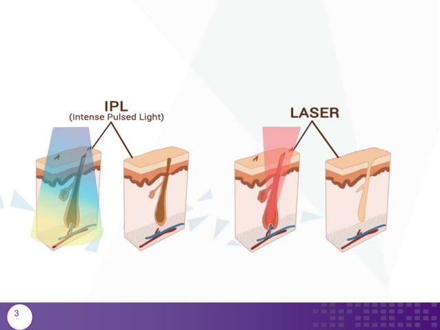 Χρήση της τεχνολογίας Έντονου Παλμικού Φωτός (IPL) και Laser για μόνιμη ...