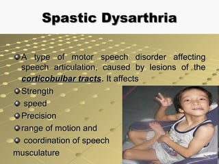 Dysarthia | PPT