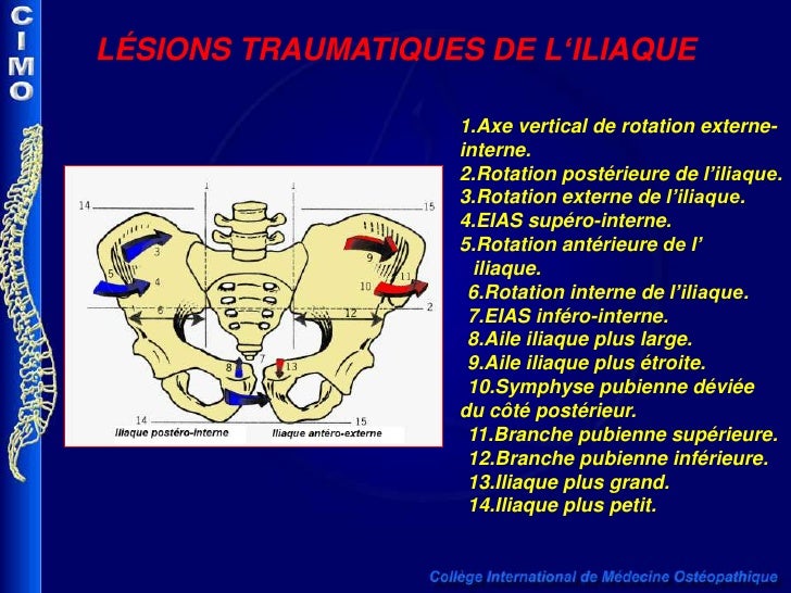 Dysfonction iliaque int externe exemple web
