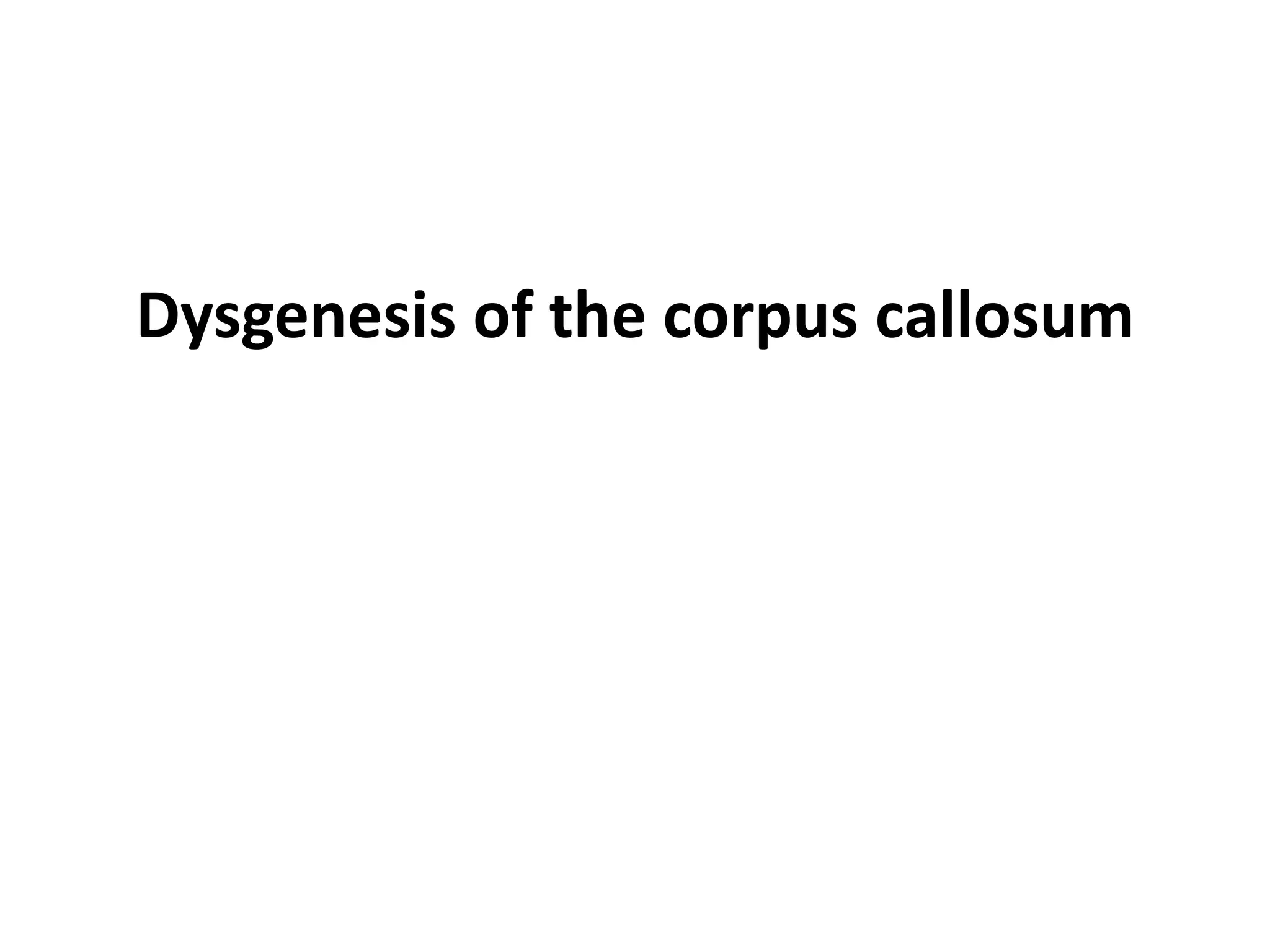 Dysgenesis of the corpus callosum | PPTX