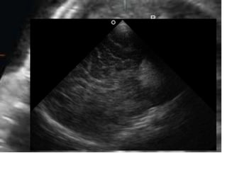 Dysgenesis of the corpus callosum | PPT
