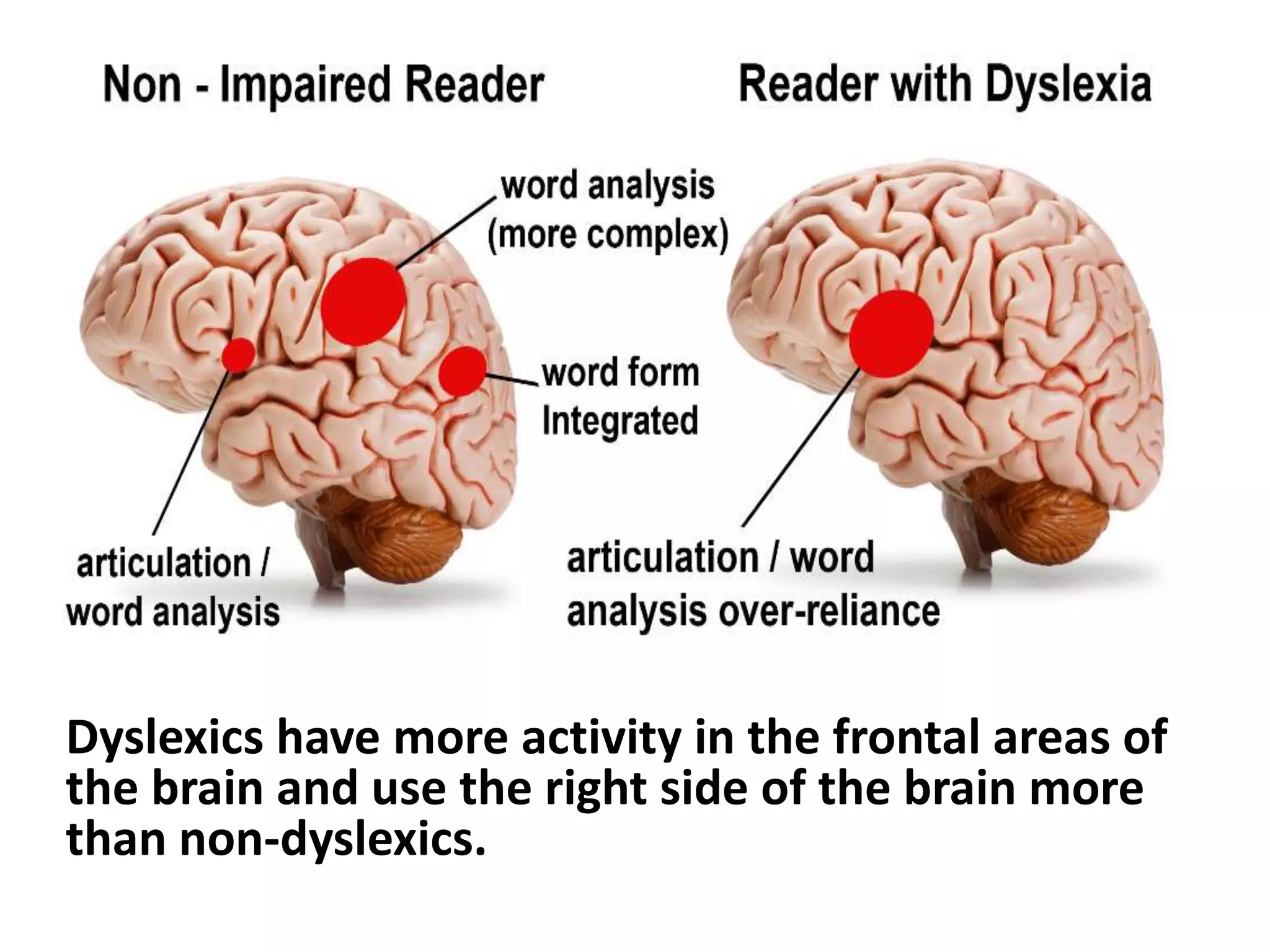 Dyslexia presentation | PPTX