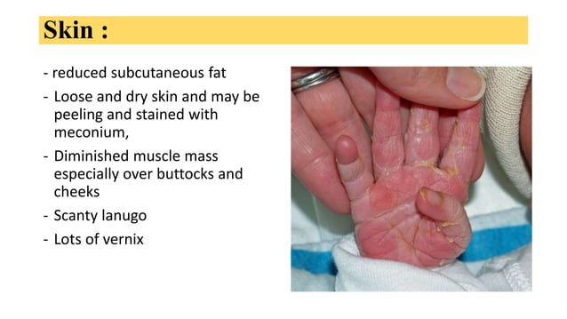 Dysmaturity.pptx | Pregnancy | Reproductive Health
