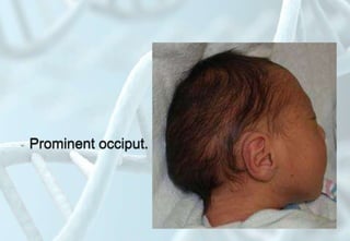 Prominent Occiput