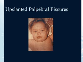 Approach to Dysmorphic Infant or Child | PPTX