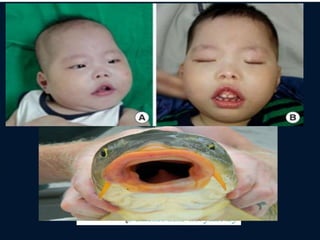 Approach to Dysmorphic Infant or Child | PPTX