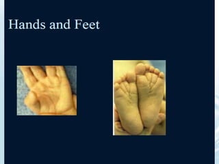 Approach to Dysmorphic Infant or Child | PPTX