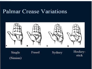 Hockey Stick Palmar Crease