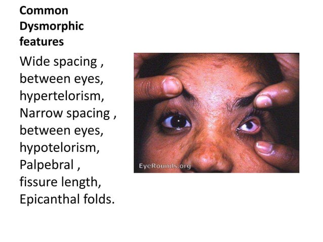 Dysmorphism | PPTX