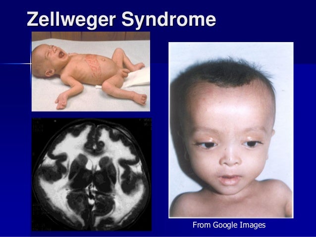 Dysmyelination Syndromes