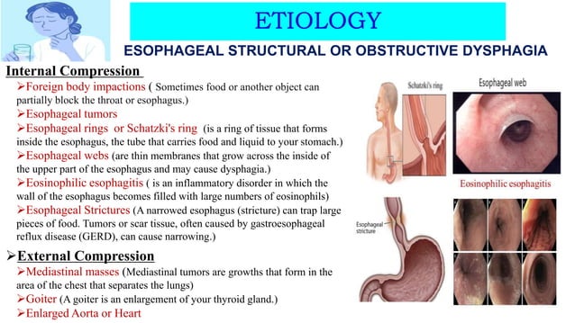 DYSPHAGIA.pptx | Ear, Nose and Throat Conditions | Diseases and Conditions