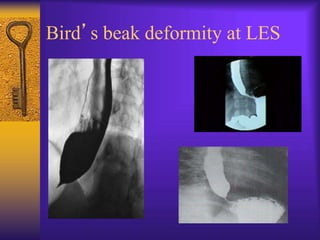 dysphagia disease.ppt